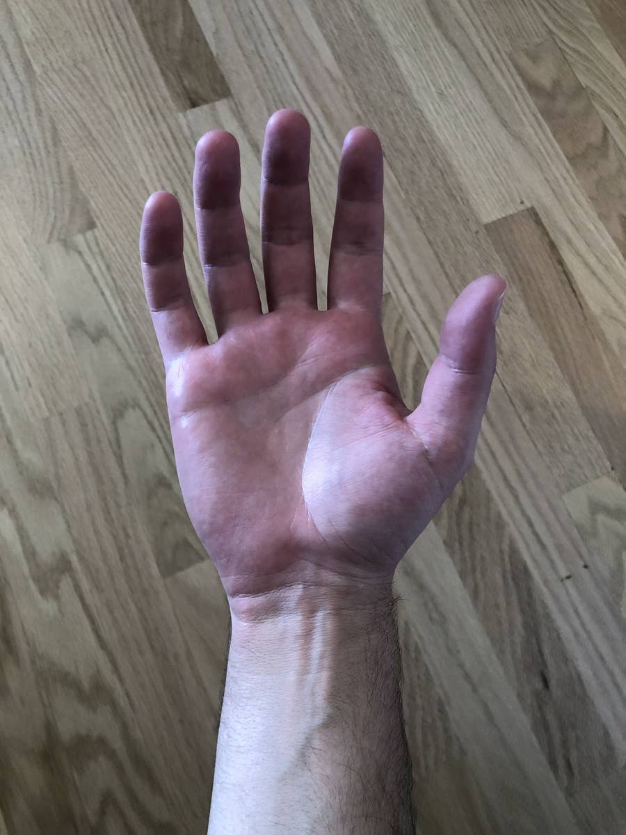 palmaris longus tendon missing