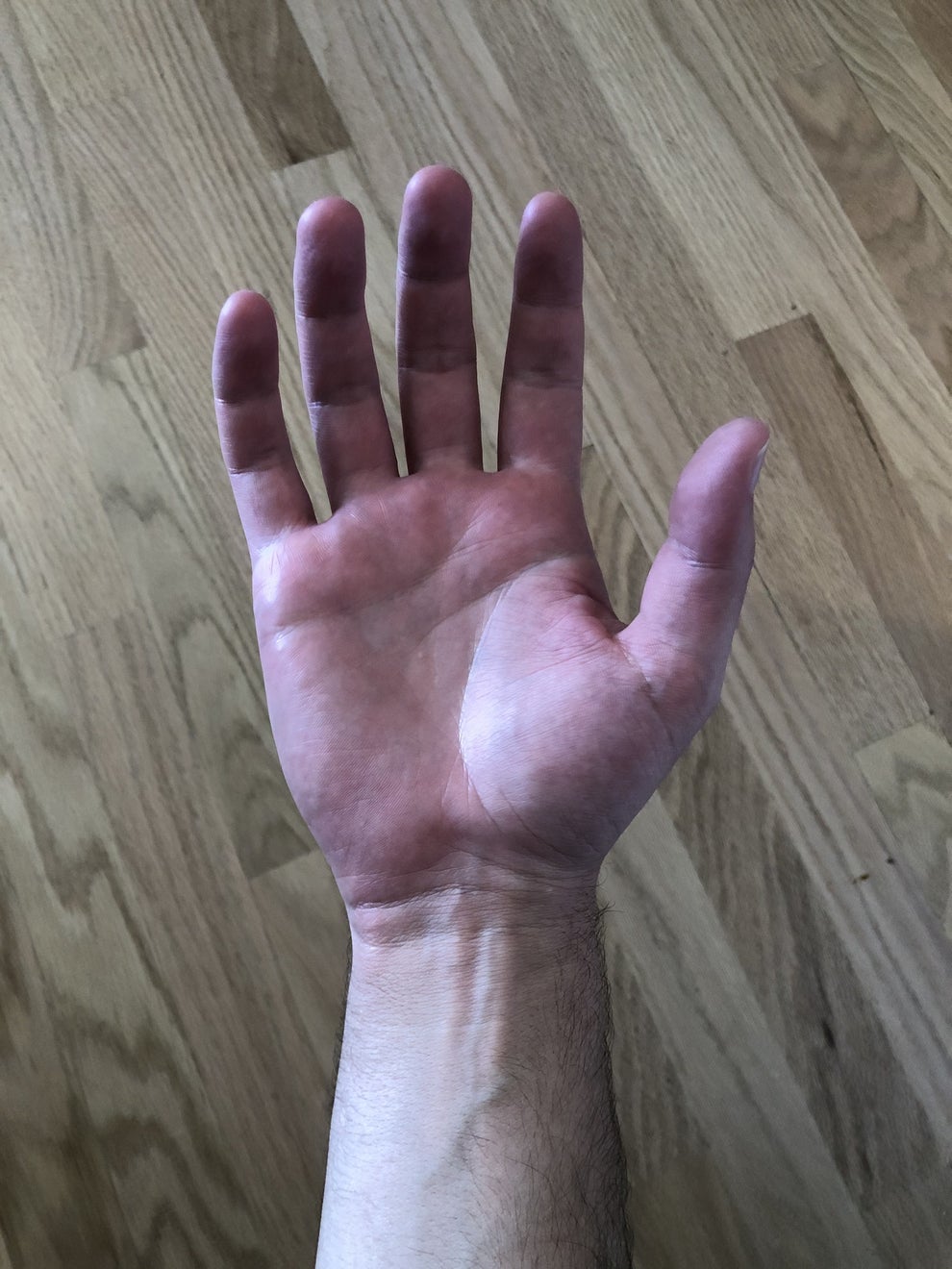 Palmaris Longus Muscle Missing In 14% Of People