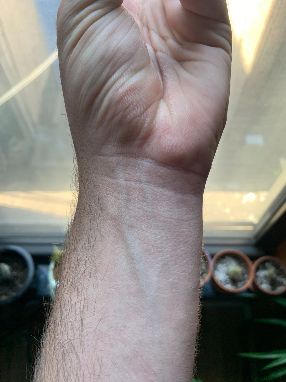 Palmaris Longus Muscle Missing In 14% Of People