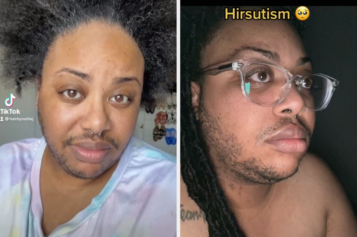 mild hirsutism examples