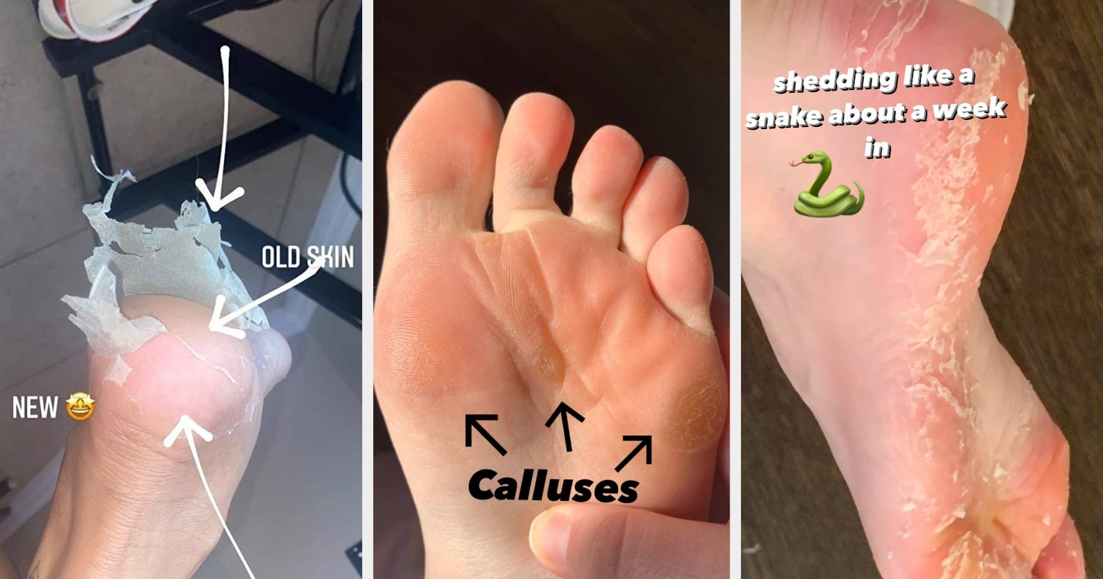 Soaking Dead Skin Off Feet