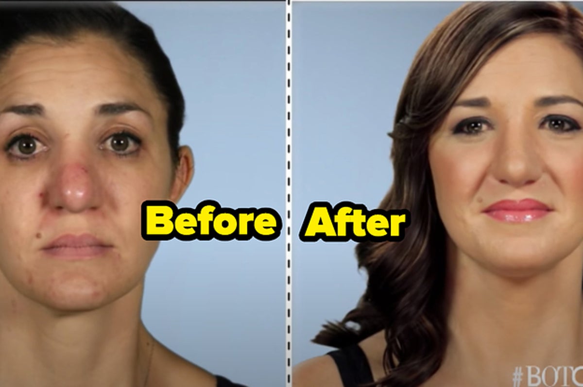 Emily Ratajkowski Before And After Plastic Surgery