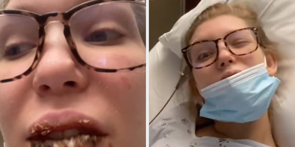 accutane side effects lips