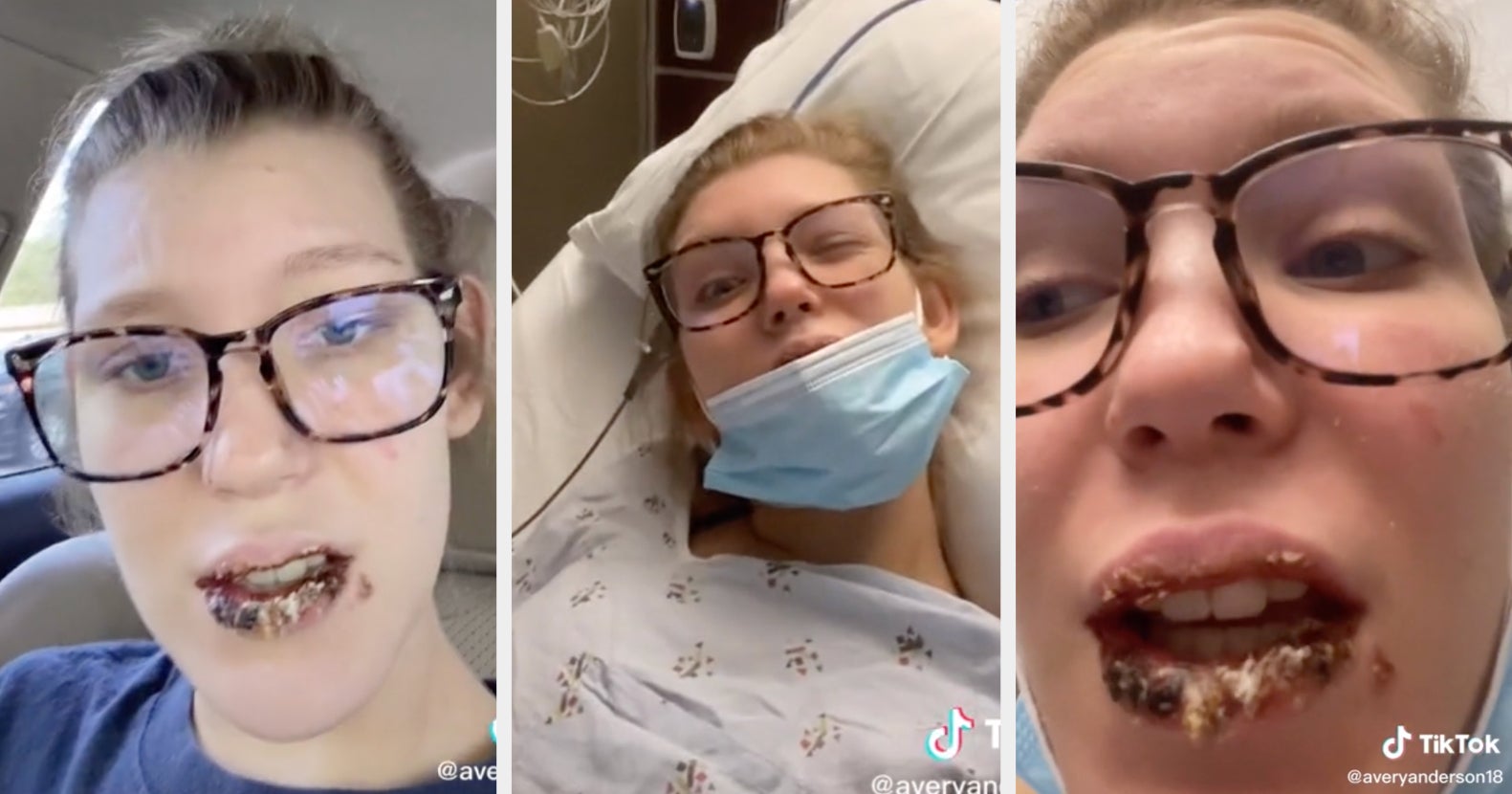 accutane burning lips