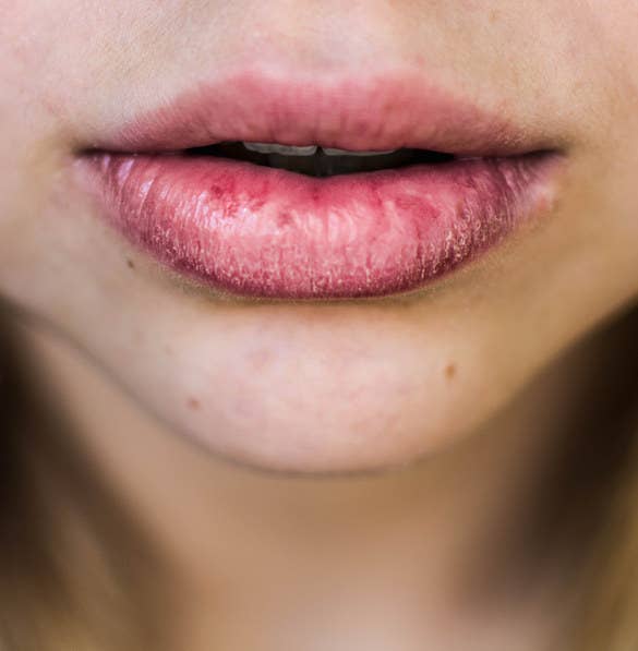 accutane side effects lips