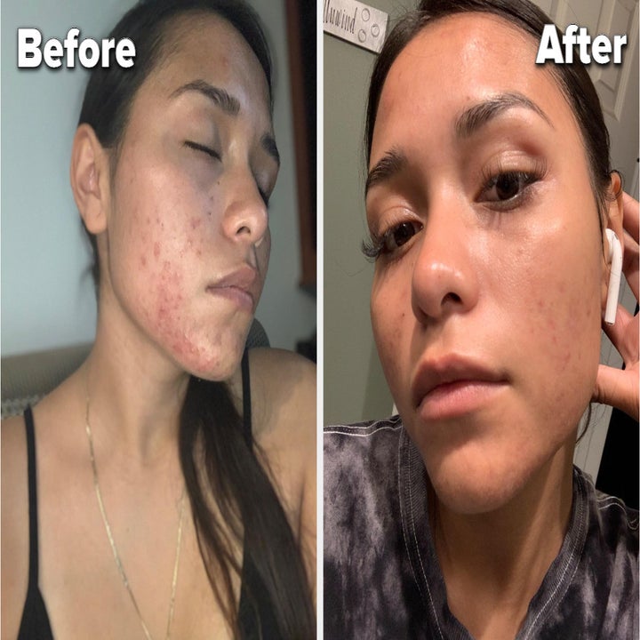 33 Skincare Products That'll Reduce Redness Real Fast