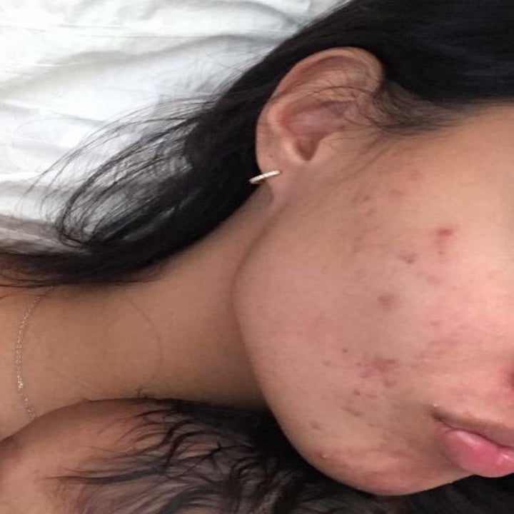 28 Beauty Products If You’ve Been Battling Acne For Years