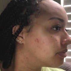 28 Beauty Products If You’ve Been Battling Acne For Years