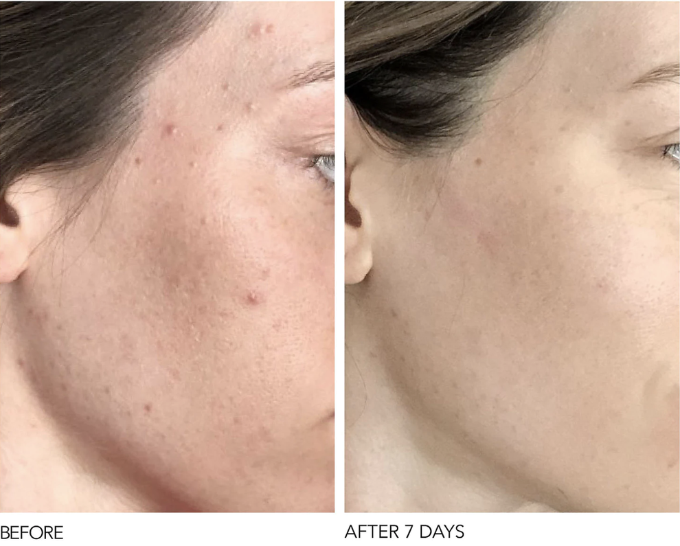 28 Skincare Products With Dramatic Before & After Photos