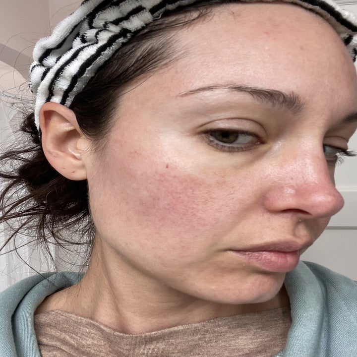 I Developed Rosacea And Hyperpigmentation After Laser Treatment