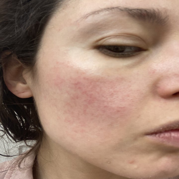 I Developed Rosacea And Hyperpigmentation After Laser Treatment