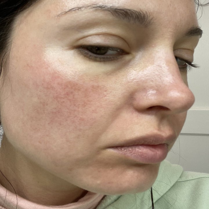 I Developed Rosacea And Hyperpigmentation After Laser Treatment