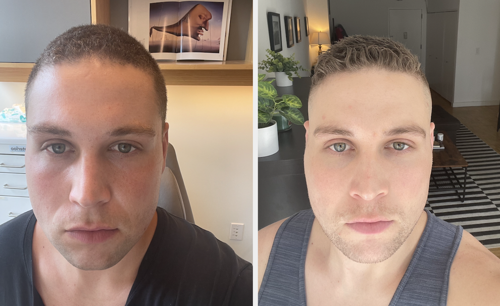 I Tried Jawline Filler And Kybella To Sculpt My Face