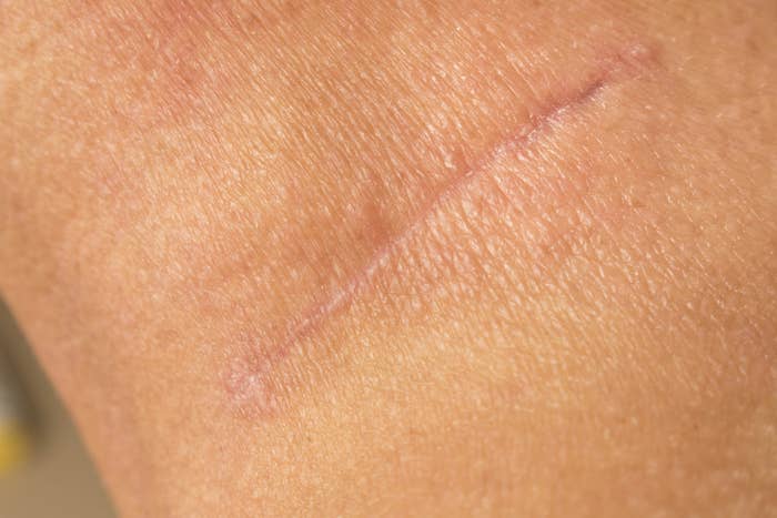 We Asked People To Share The Stories Behind Their Scars And Tell Us ...
