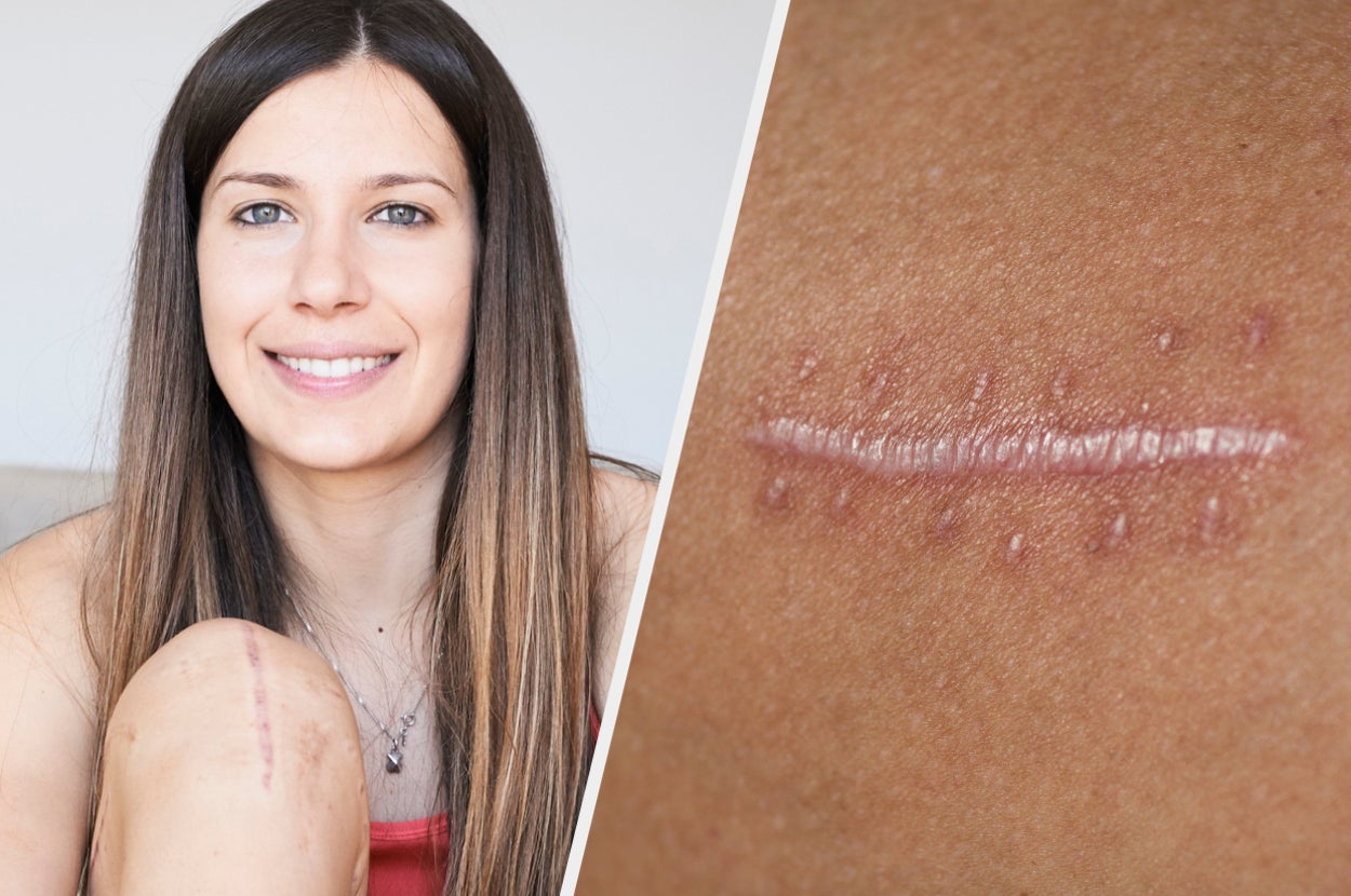 We Asked People To Share The Stories Behind Their Scars And Tell Us ...