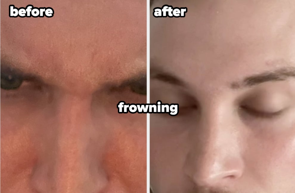 I Got Preventive Botox And This Is What Happened