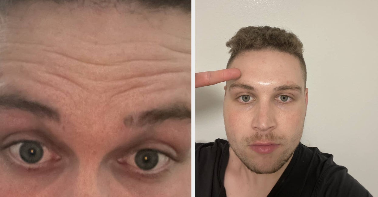 I Got Preventive Botox And This Is What Happened