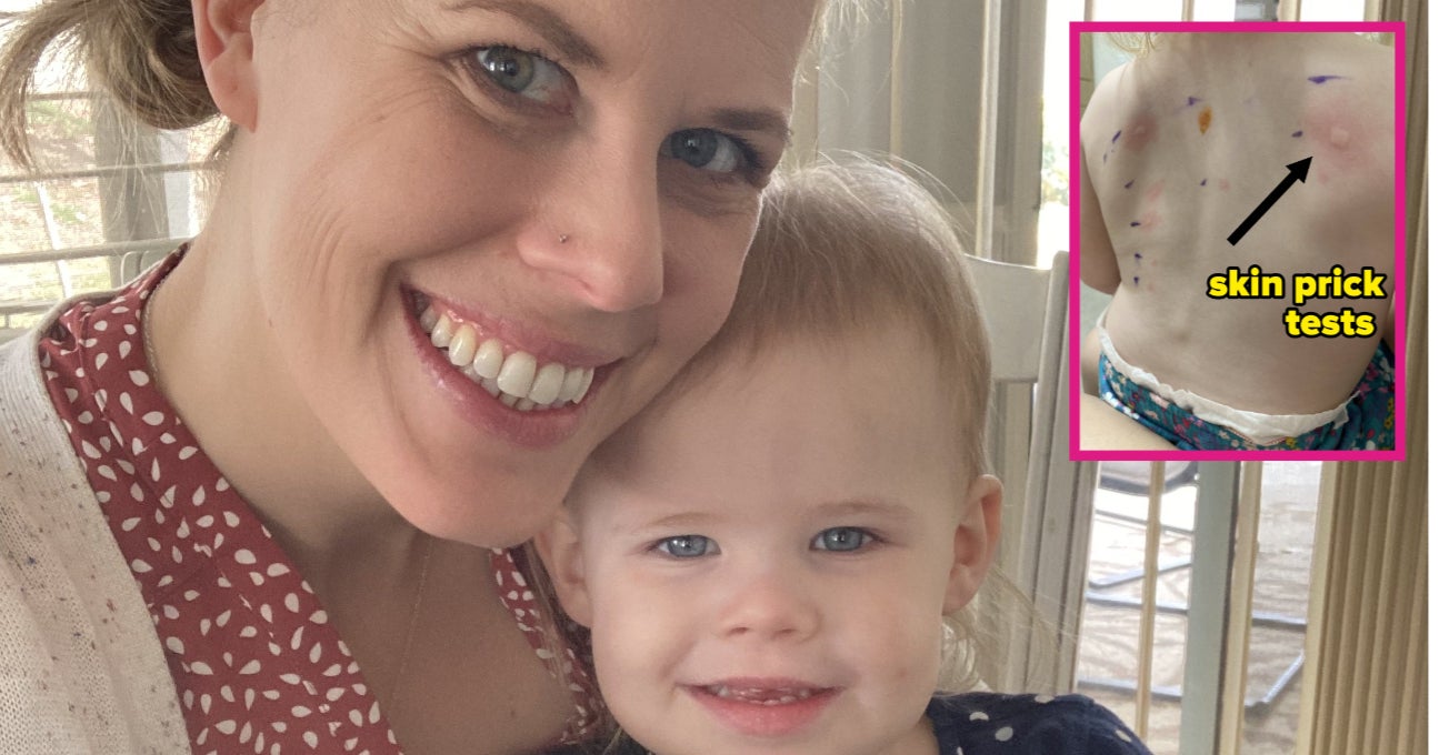 Food Allergies In Children: Symptoms, Treatment, Advice