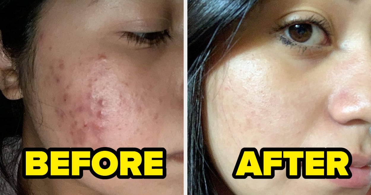 26 Skincare Before And Afters That Are Super Convincing