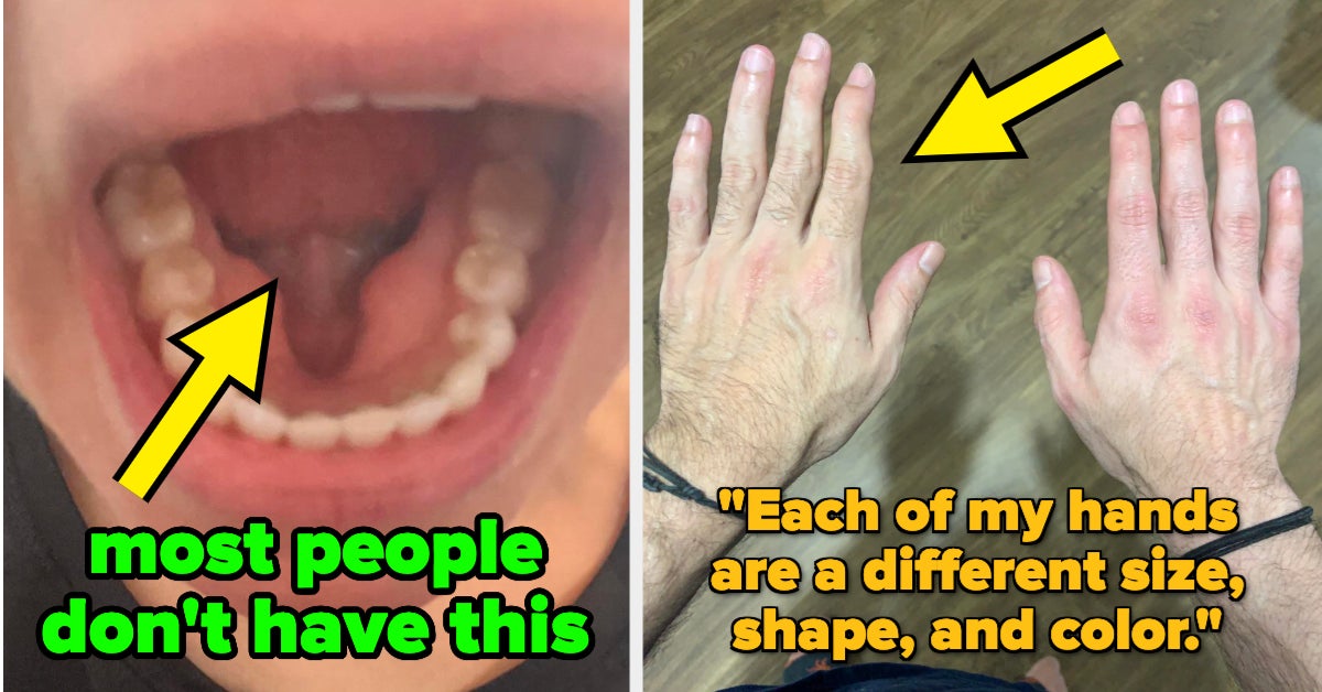 Body Abnormalities People Proudly Shared