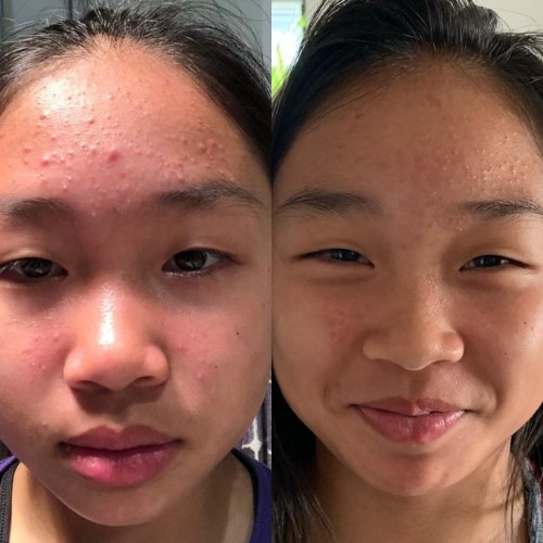 This Acne-Fighting Skincare Range Is Made With Cannabis Oil And The ...