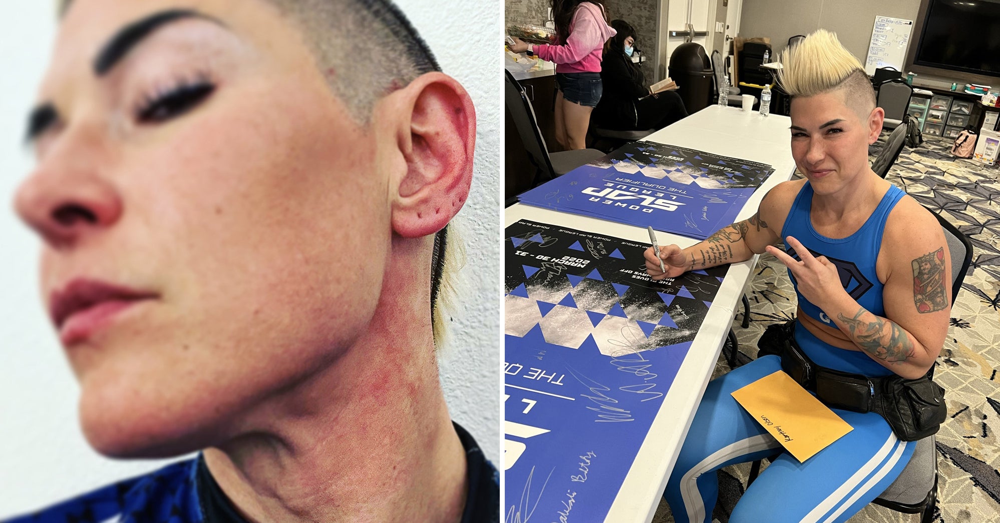 broken eye socket slap competition