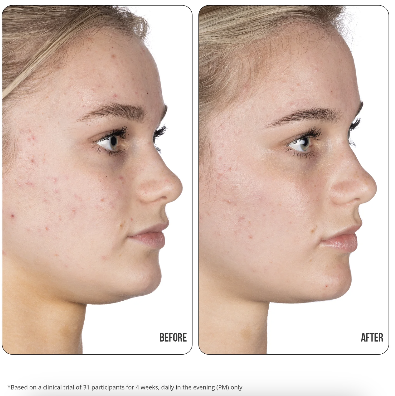 Reduce Blemishes And Pores With This Retinol Treatment
