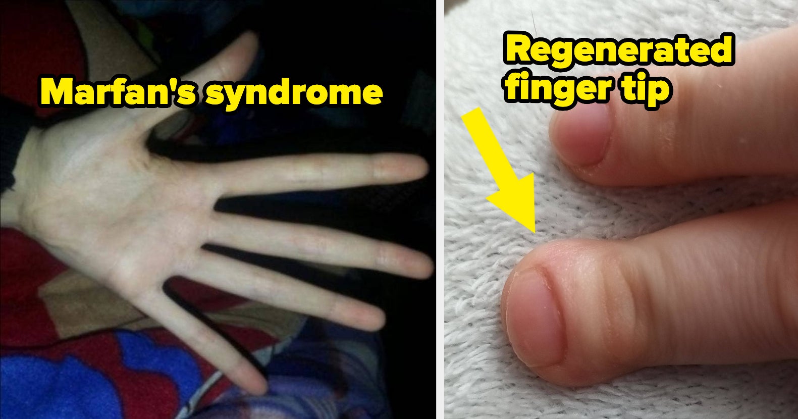 17 People Who Proudly Shared Their Fascinating Body Abnormalities Like ...