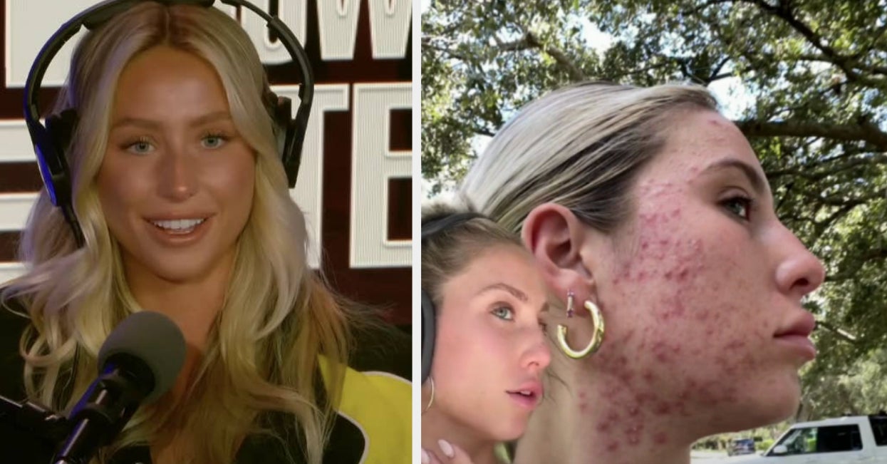 Alix Earle Talks Cystic Acne On Howard Stern