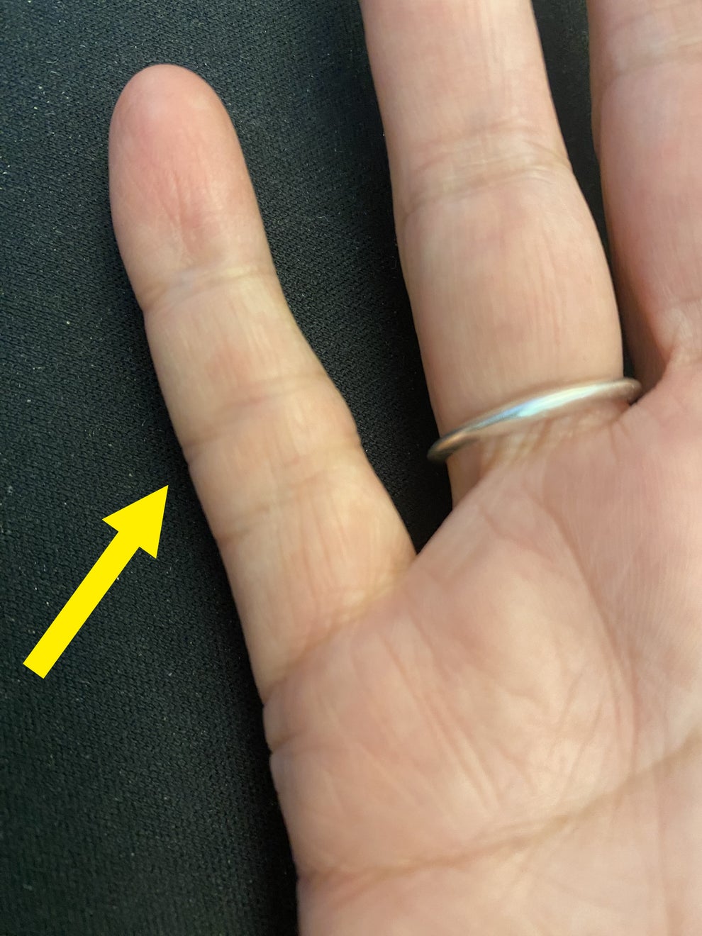 Fascinating Body Abnormalities: Extra Phalangeal Crease, Harlequin ...