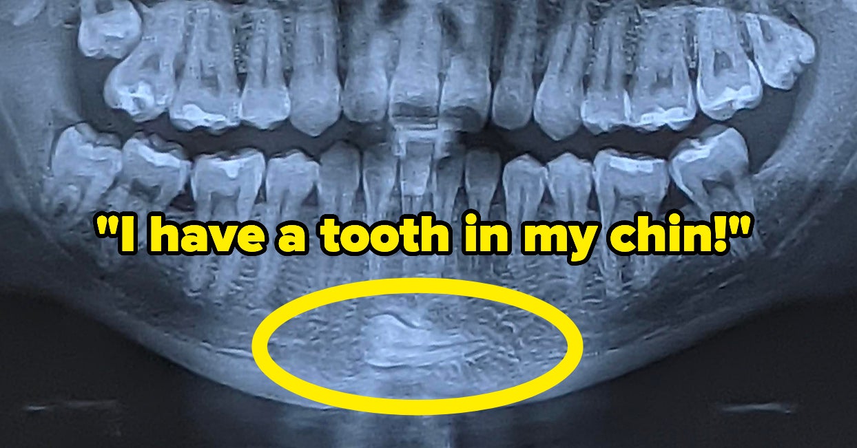 21 People Who Proudly Shared Their Fascinating Body Abnormalities Like ...