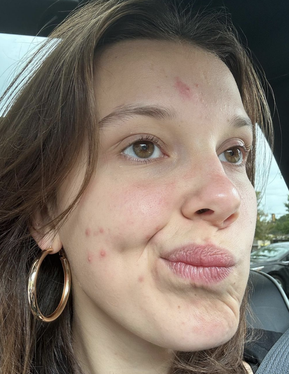 Millie Bobby Brown Posts Selfie With Acne