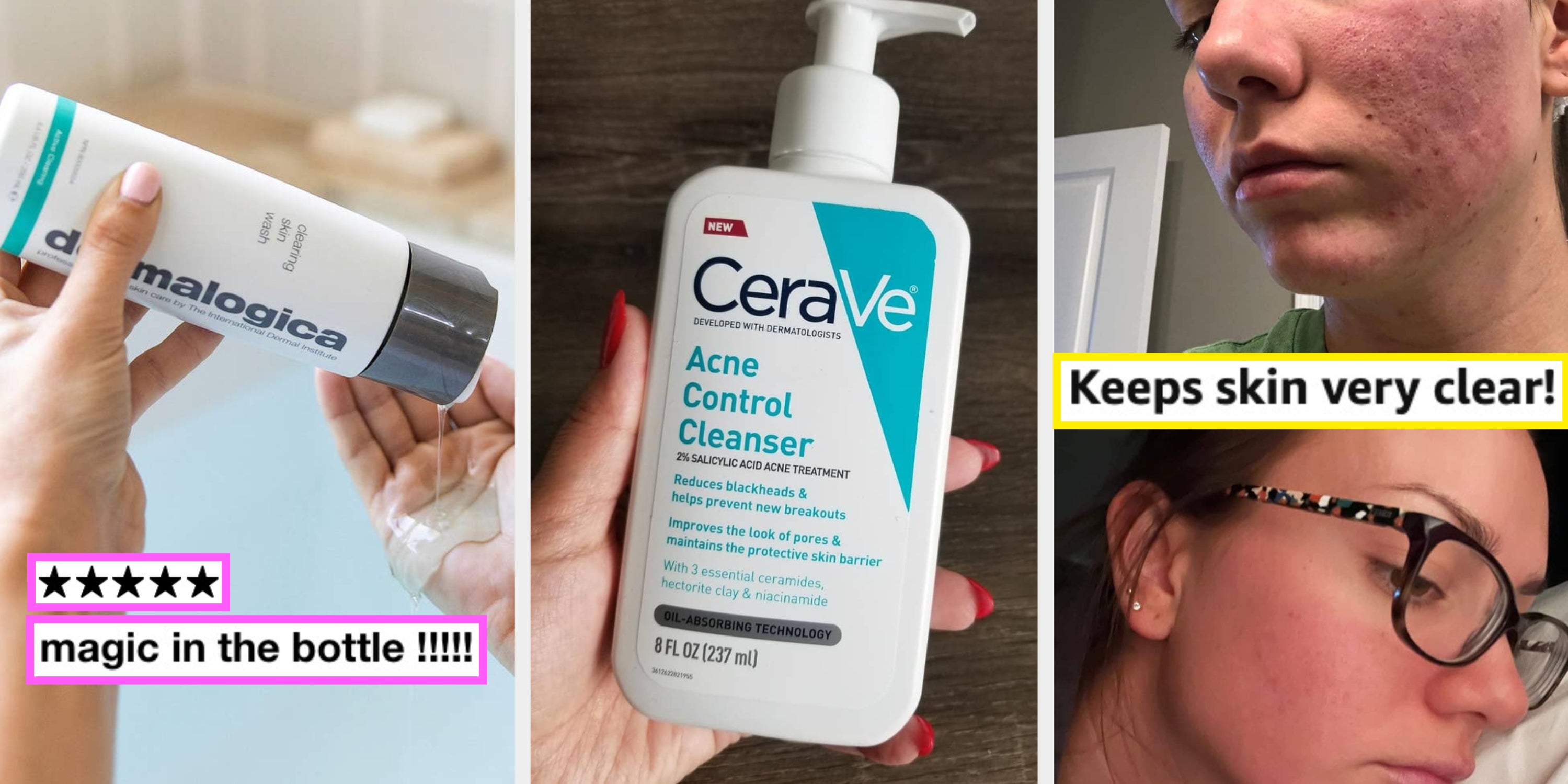 salicylic acid face wash acne