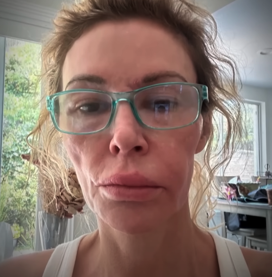Brandi Glanville Says She Has A Potential Face Parasite