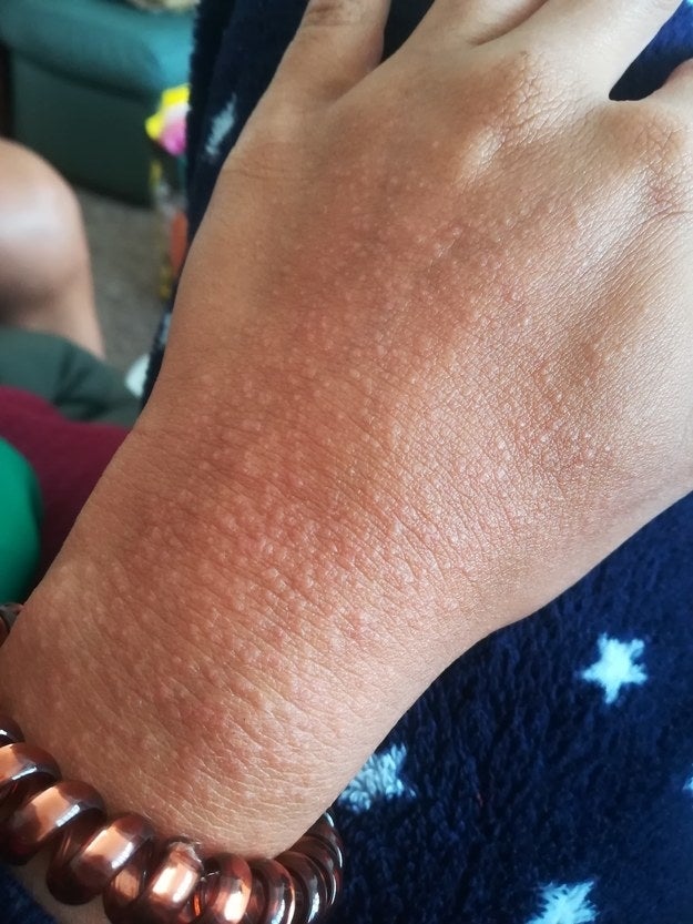 29 Worst Allergic Reaction Pictures And Stories