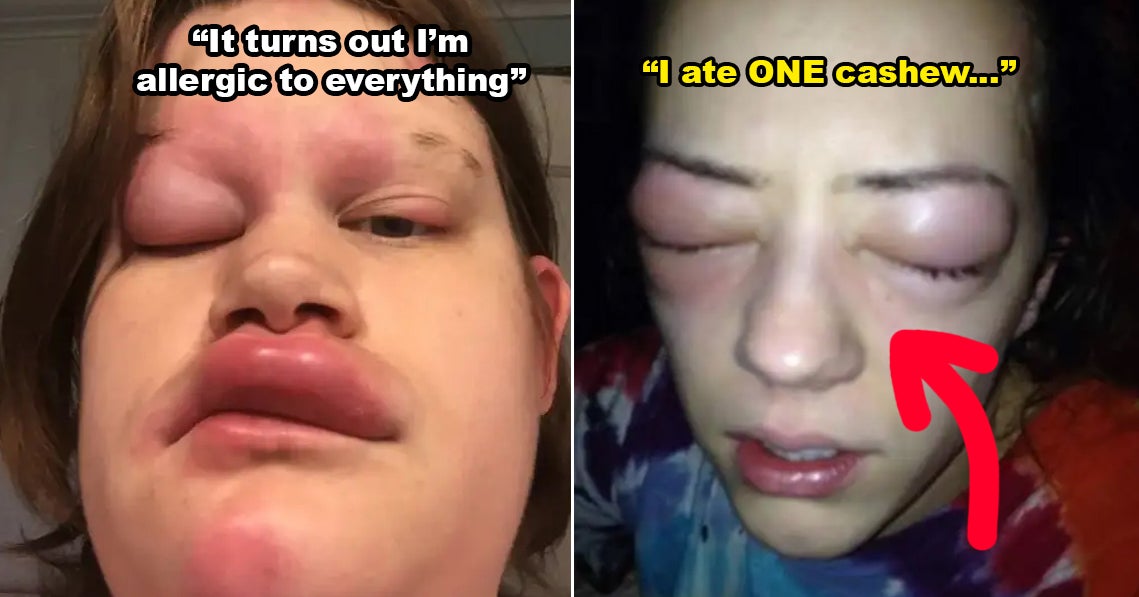 29 Worst Allergic Reaction Pictures And Stories