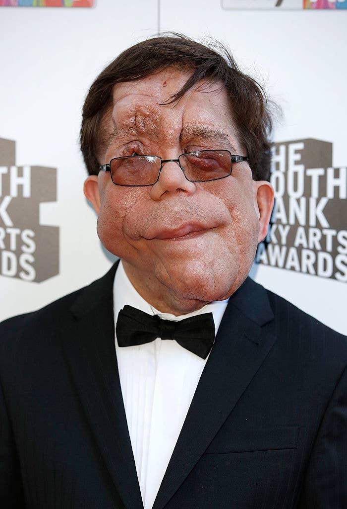Adam Pearson Responds To Disgusting Online Comments