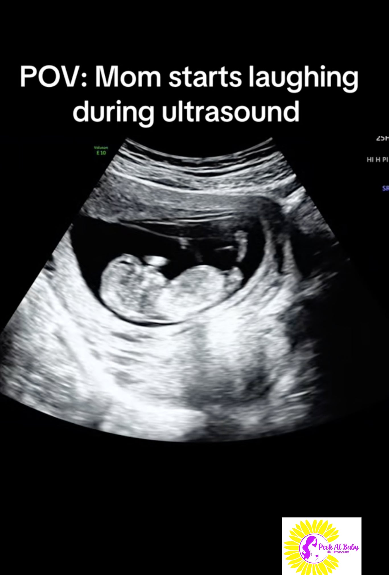 Laughing During Pregnancy TikTok Ultrasound