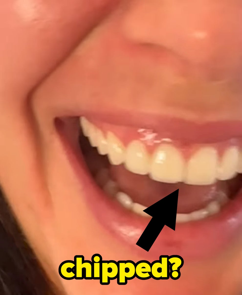 Kendall Jenner's Chipped Tooth With Kylie And Timothée