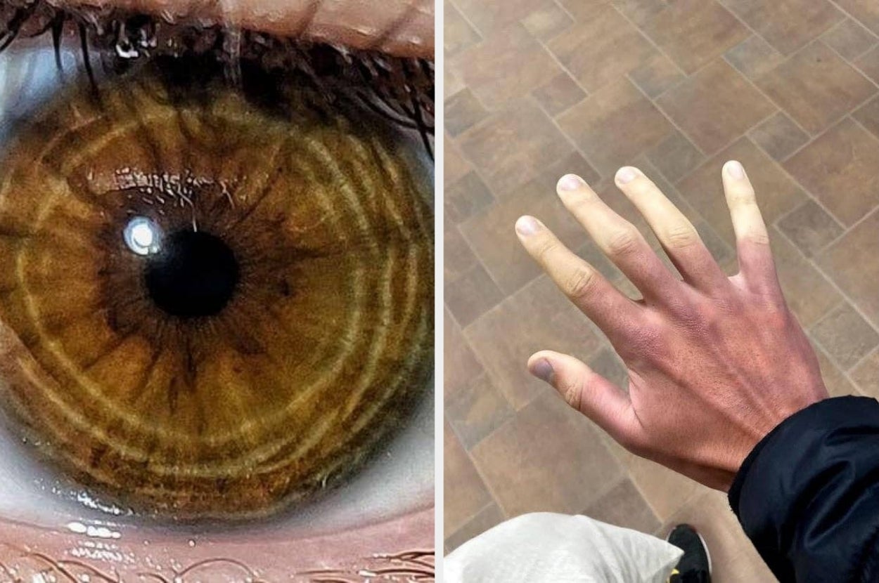 eye furrows patterns