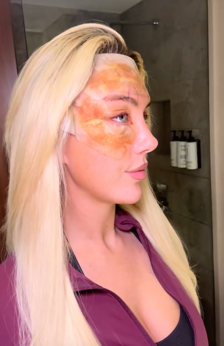 Patsy Field Posts Fox Eye Surgery Results