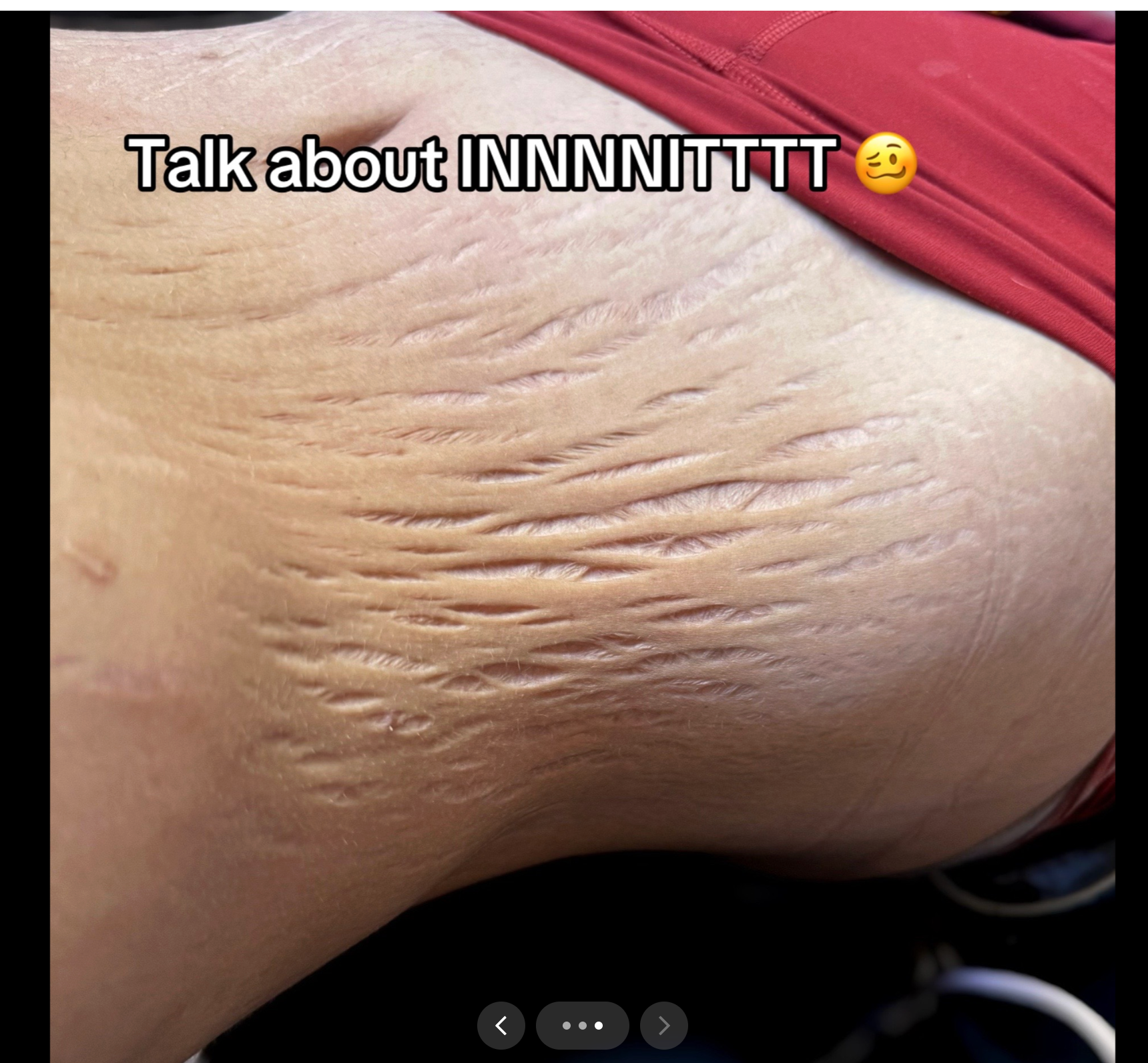 worst stretch marks ever