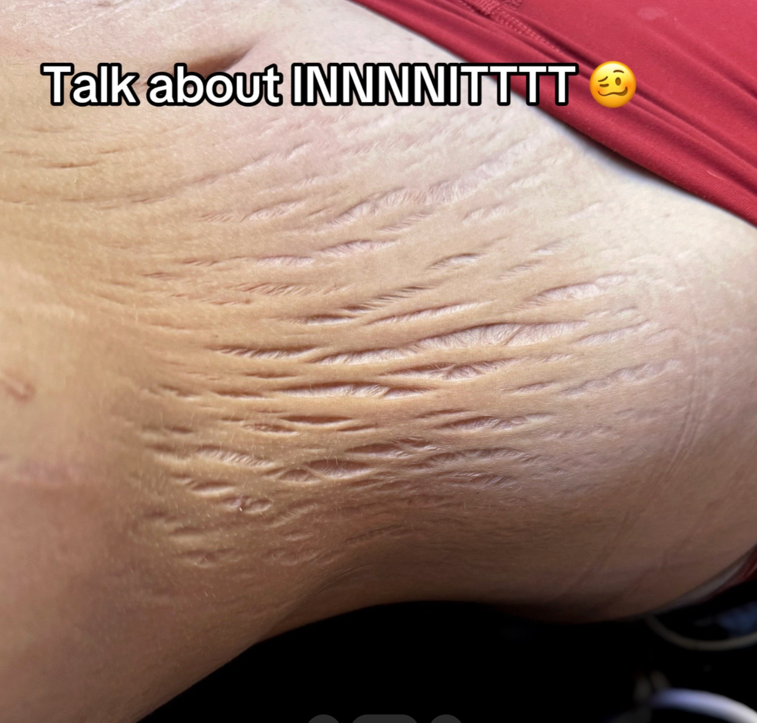 Mom Shows What Deep Stretch Marks Look Like After Pregnancy