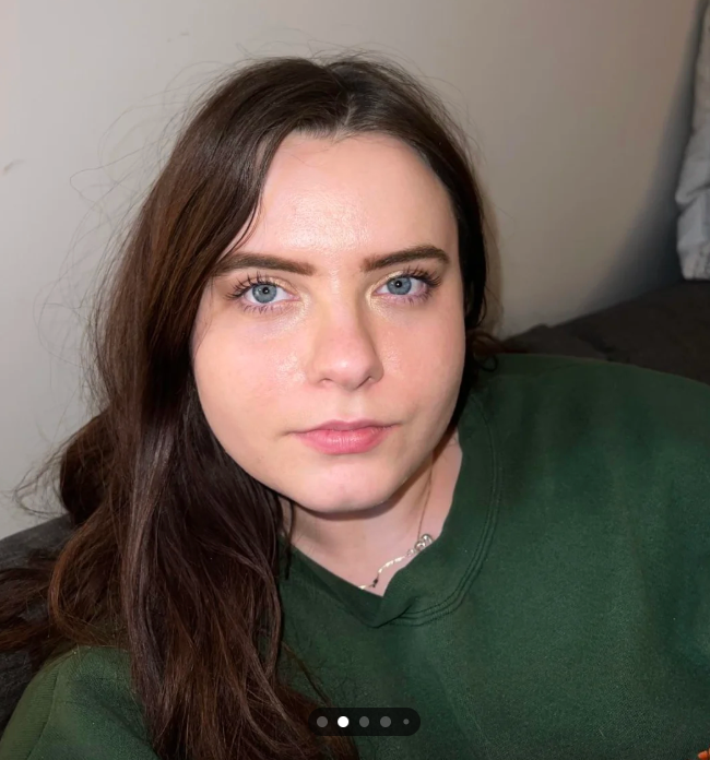 Reddit Woman's Non-Surgical Facial Transformation