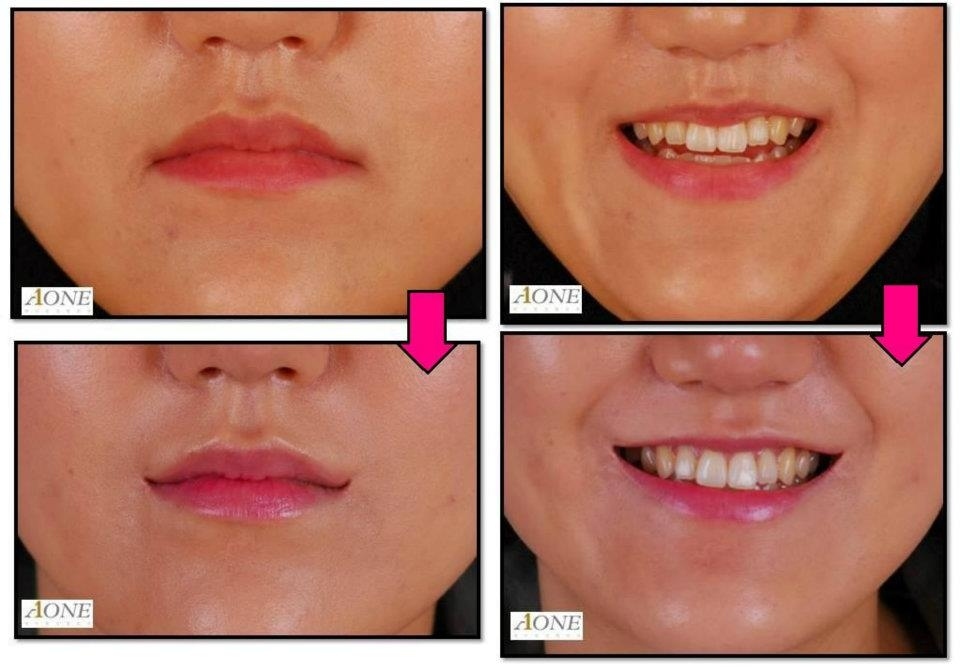 Plastic Surgery That Forces You To Smile Uncontrollably Is All The Rage ...