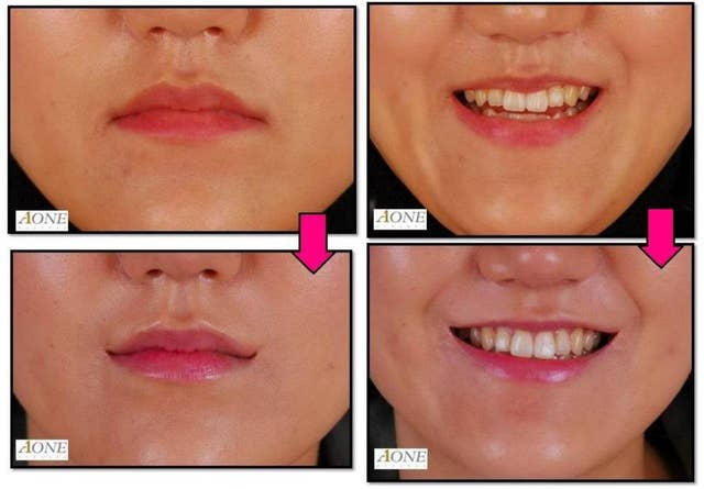 How To Smile With Downturned Lips | Lipstutorial.org
