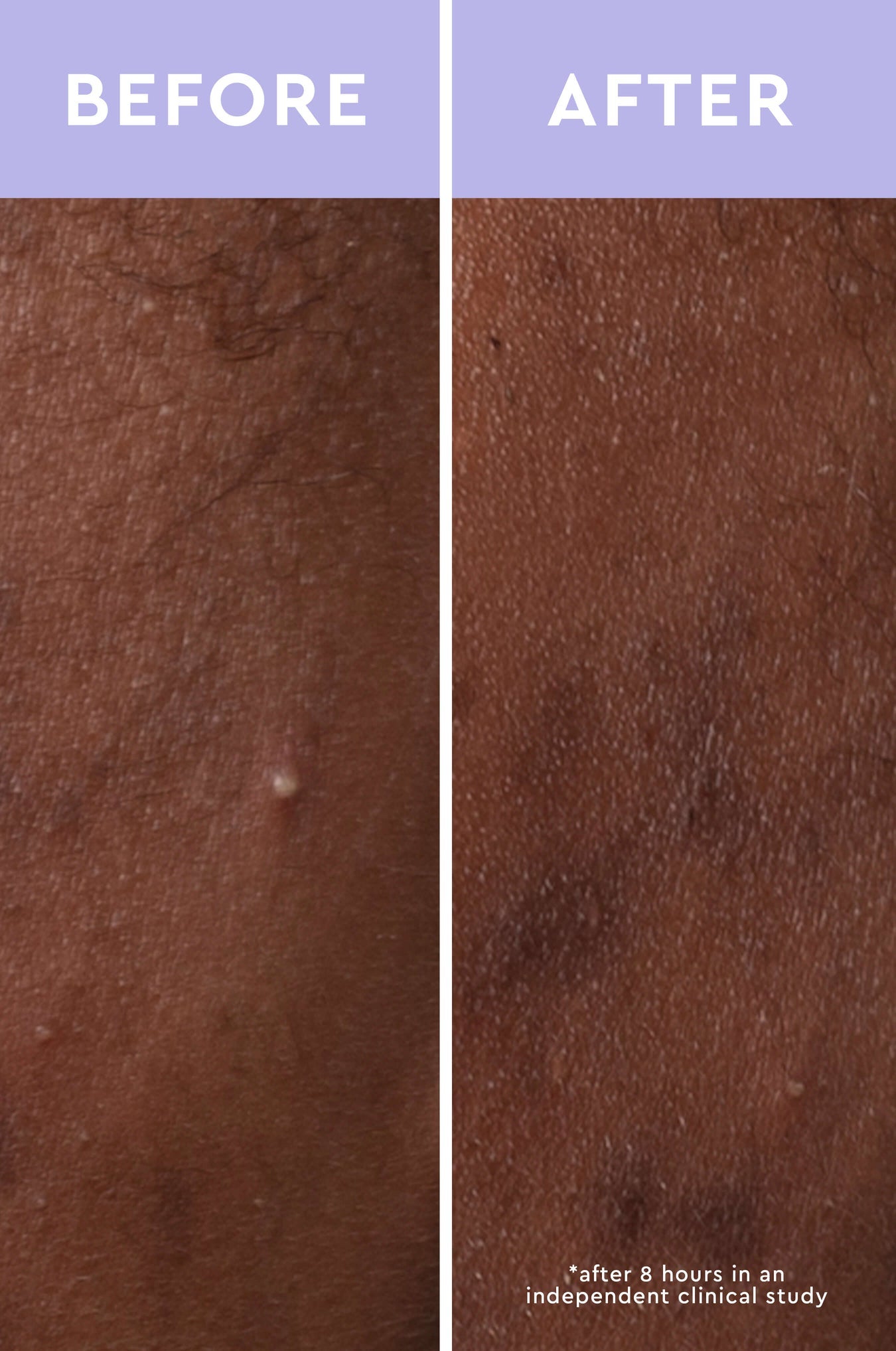 21 Best Pimple Patches To Clear Up Your Skin In 2022