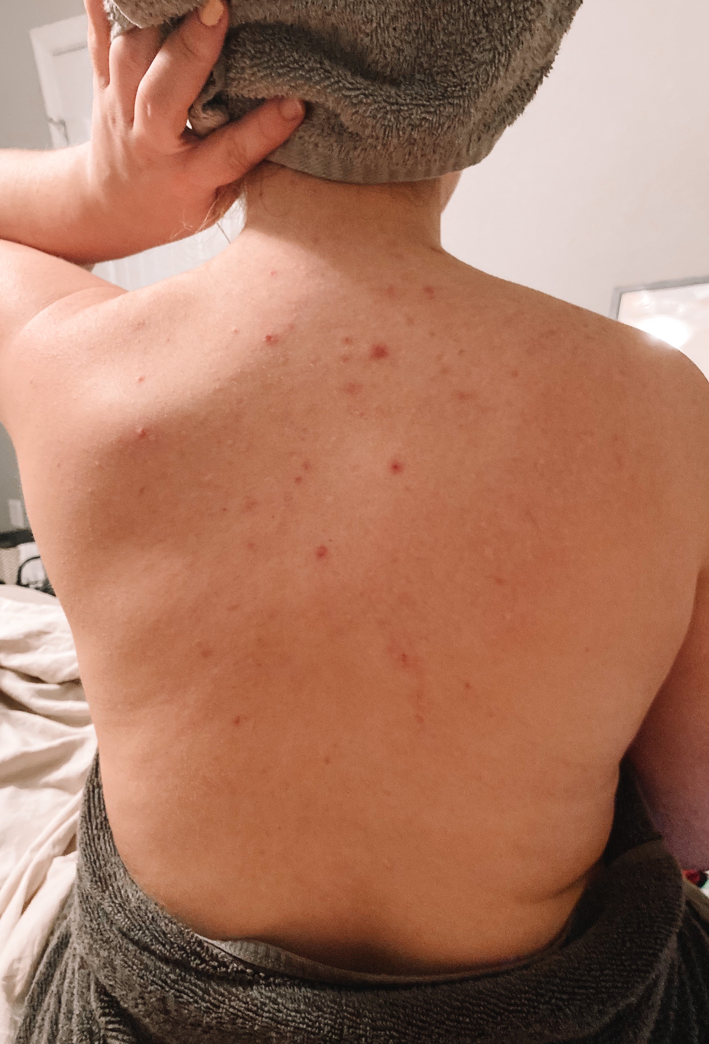 24 Products For Summer Breakouts