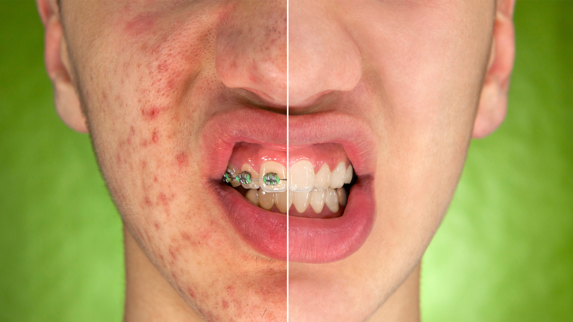 People Confess Their Acne Stories